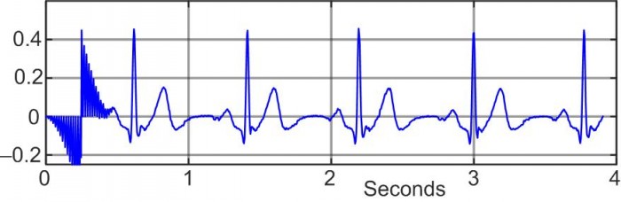 60-Hz Noise and Baseline Drift Reduction in ECG Signal Processing - Rick Lyons